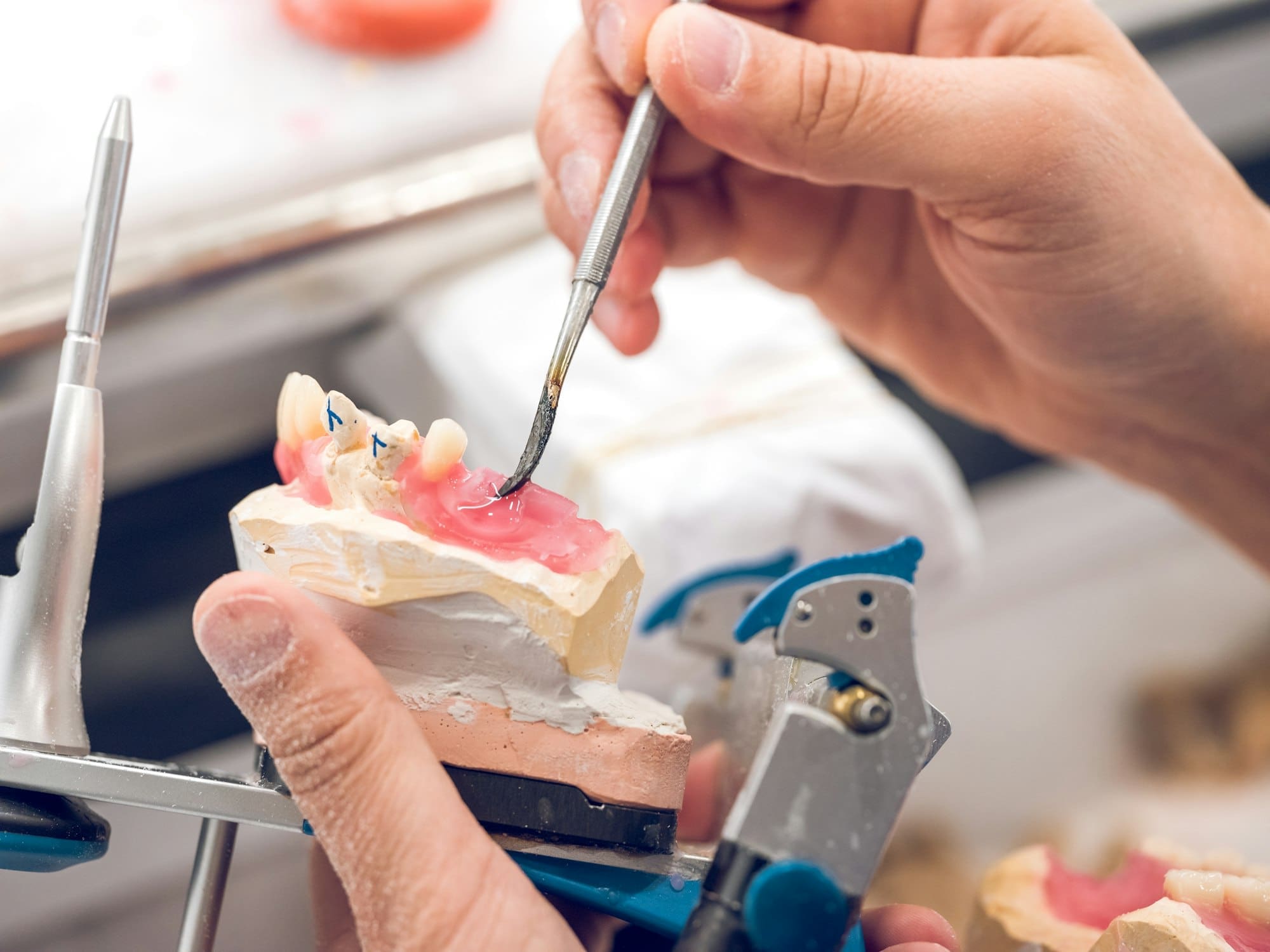 Wax Patterns In Dental Restorations: A Comprehensive Guide • Land Of Smile